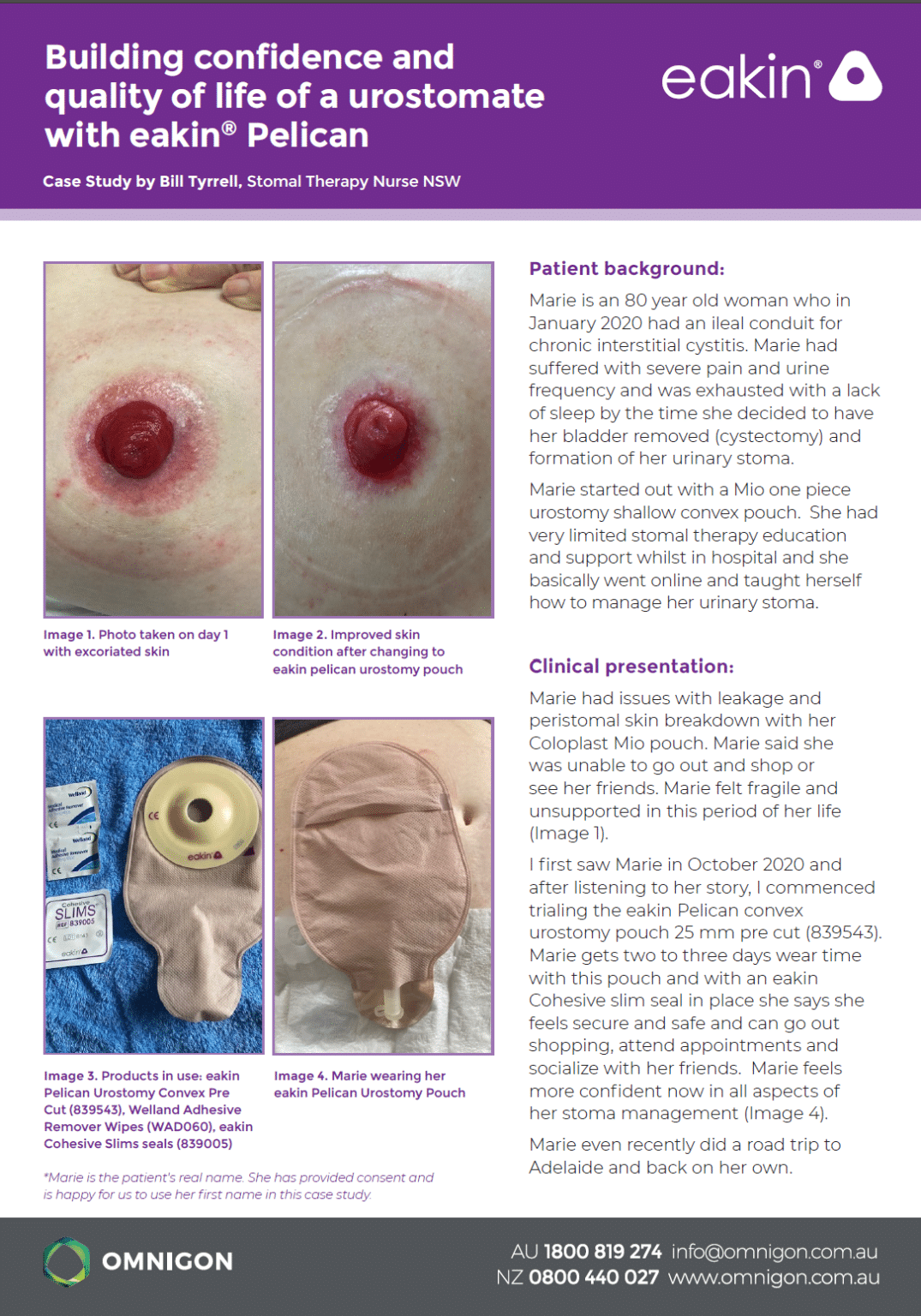 Building Confidence and QOL of a Urostomate with eakin Pelican | Omnigon