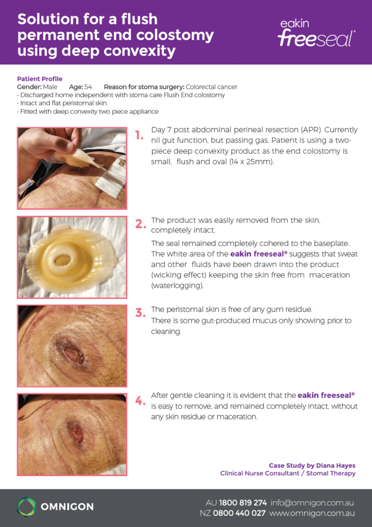 Solution for a flush permanent end colostomy using deep convexity | Omnigon