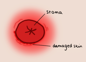 What is Excoriation? | Omnigon